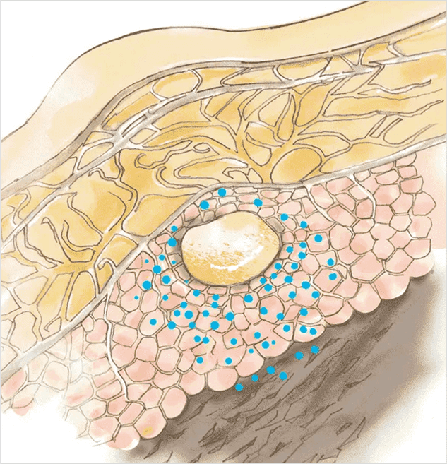 Dosing & Administration | SUBLOCADE® (buprenorphine extended-release) HCP