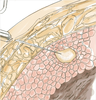 Dosing & Administration | SUBLOCADE® (buprenorphine extended-release) HCP